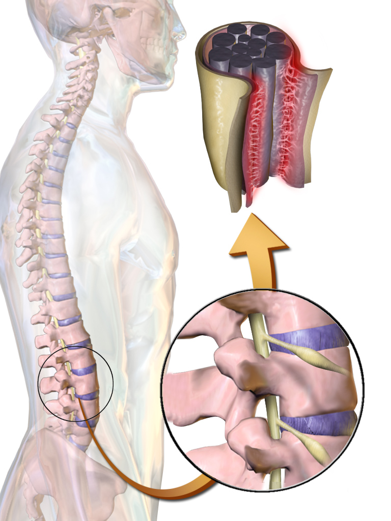 Spinal Injury Birbrower And Beldock spinal-injury-birbrower-and-beldock
